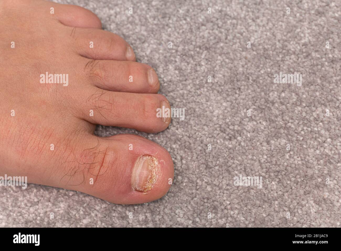 Nail diseases on left mans leg Stock Photo - Alamy