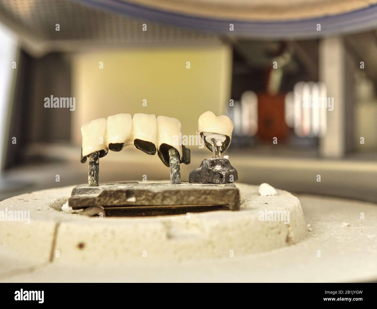 Tooth, metal ceramic crown on the table. Denture made of metal ceramics ...