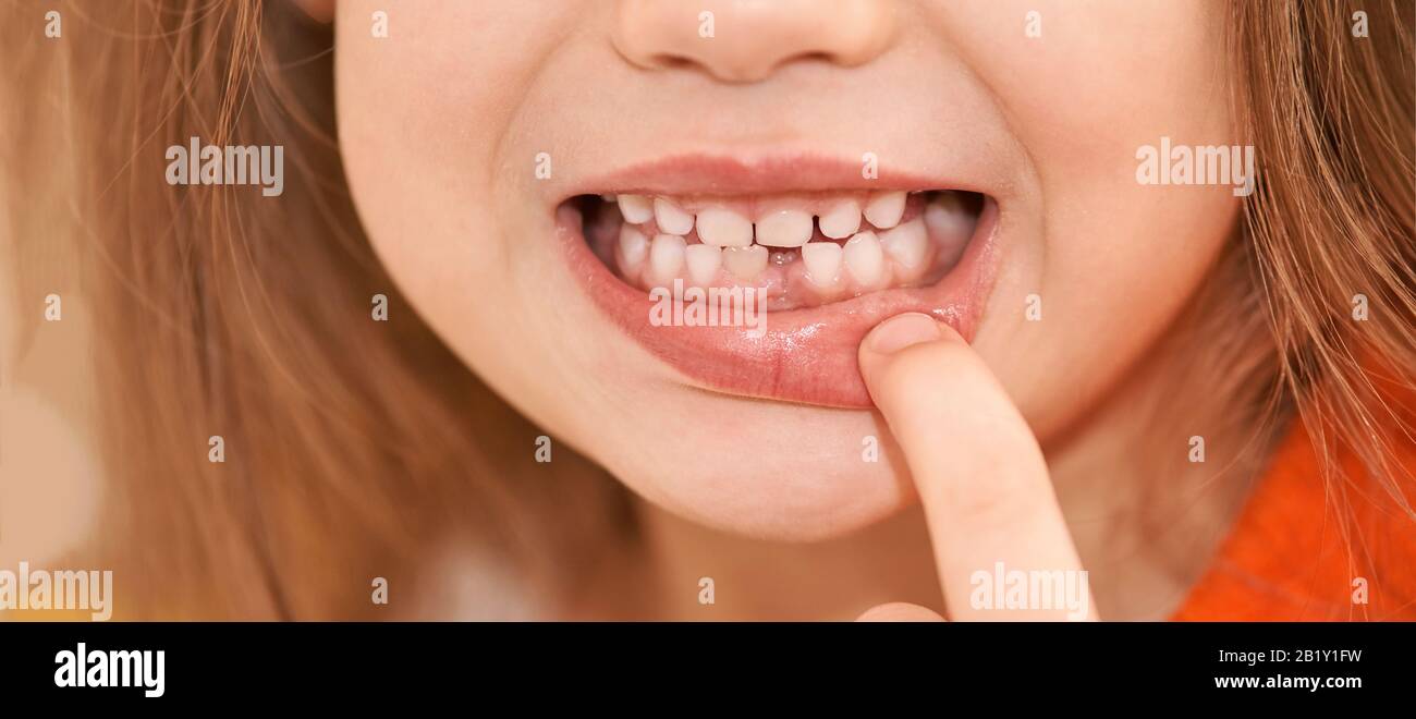 Young girl point on milk tooth. Baby losing teeth Stock Photo - Alamy