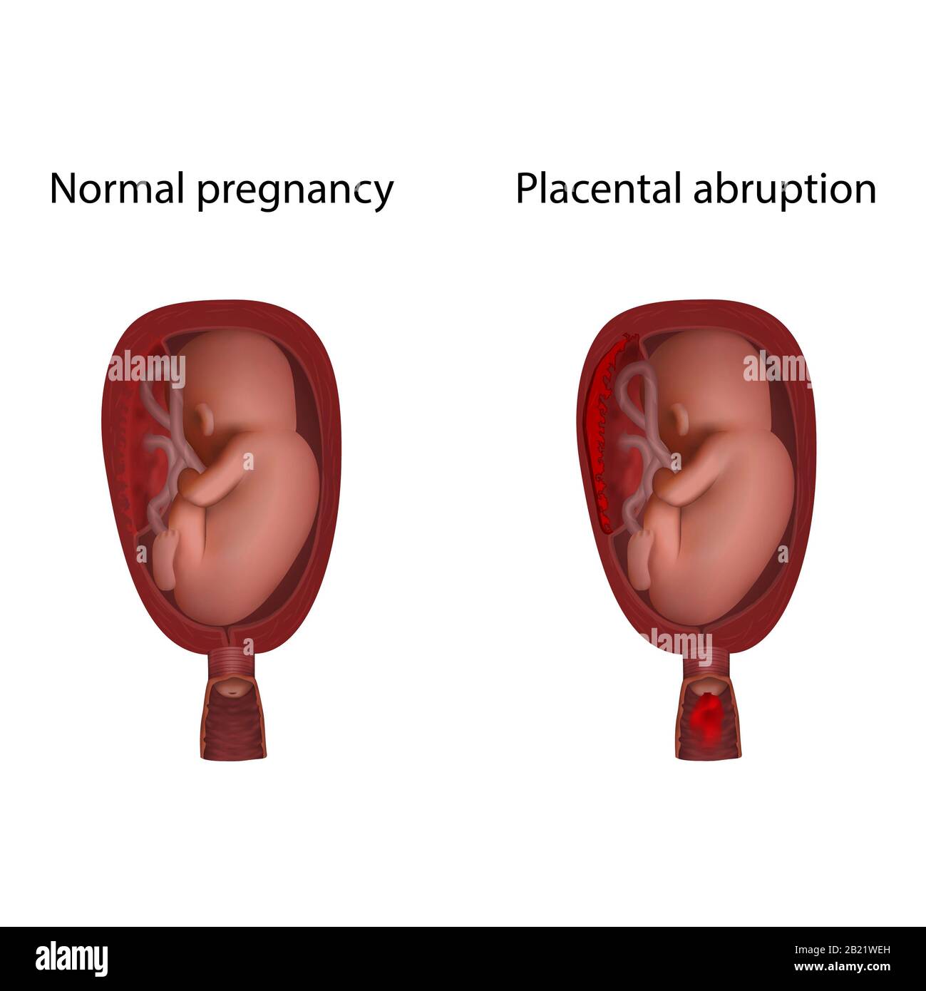 Placental Abruption Classification