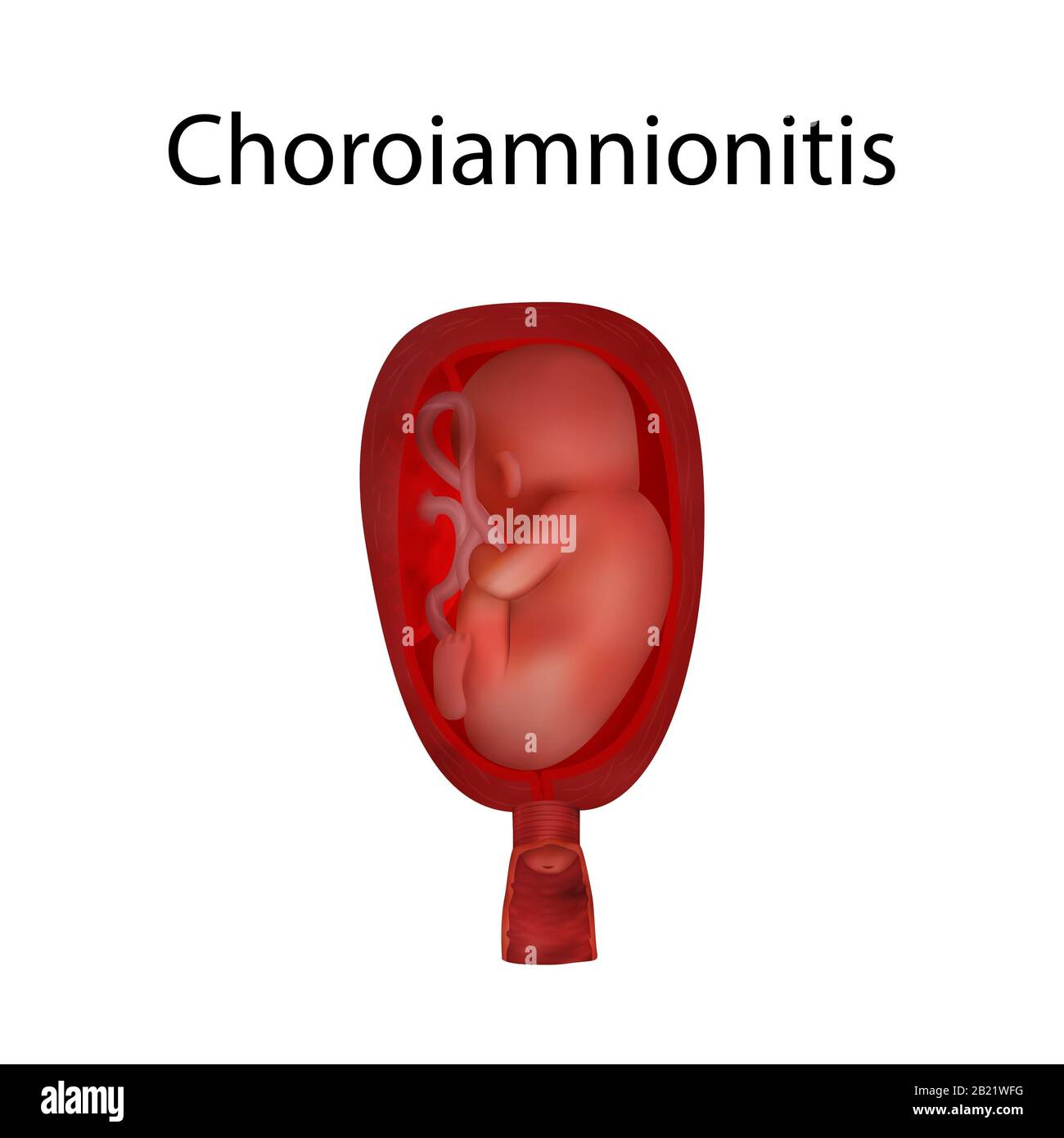 Fetal infection hi-res stock photography and images - Alamy