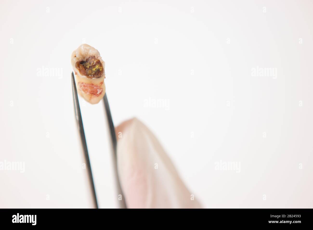 Endodontic operation hi-res stock photography and images - Alamy