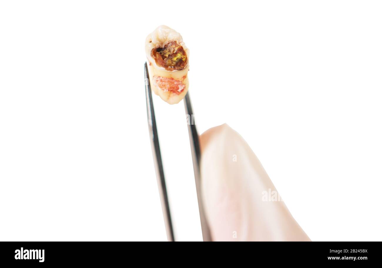 Endodontic operation Cut Out Stock Images & Pictures - Alamy
