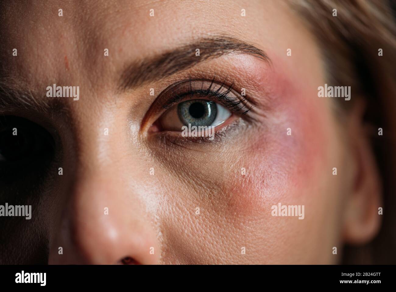 Cropped view of Victim face with bruise next to eye Stock Photo - Alamy