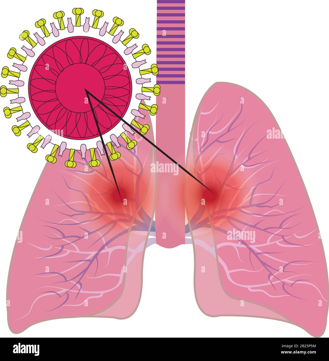 Lungs affected hi-res stock photography and images - Alamy