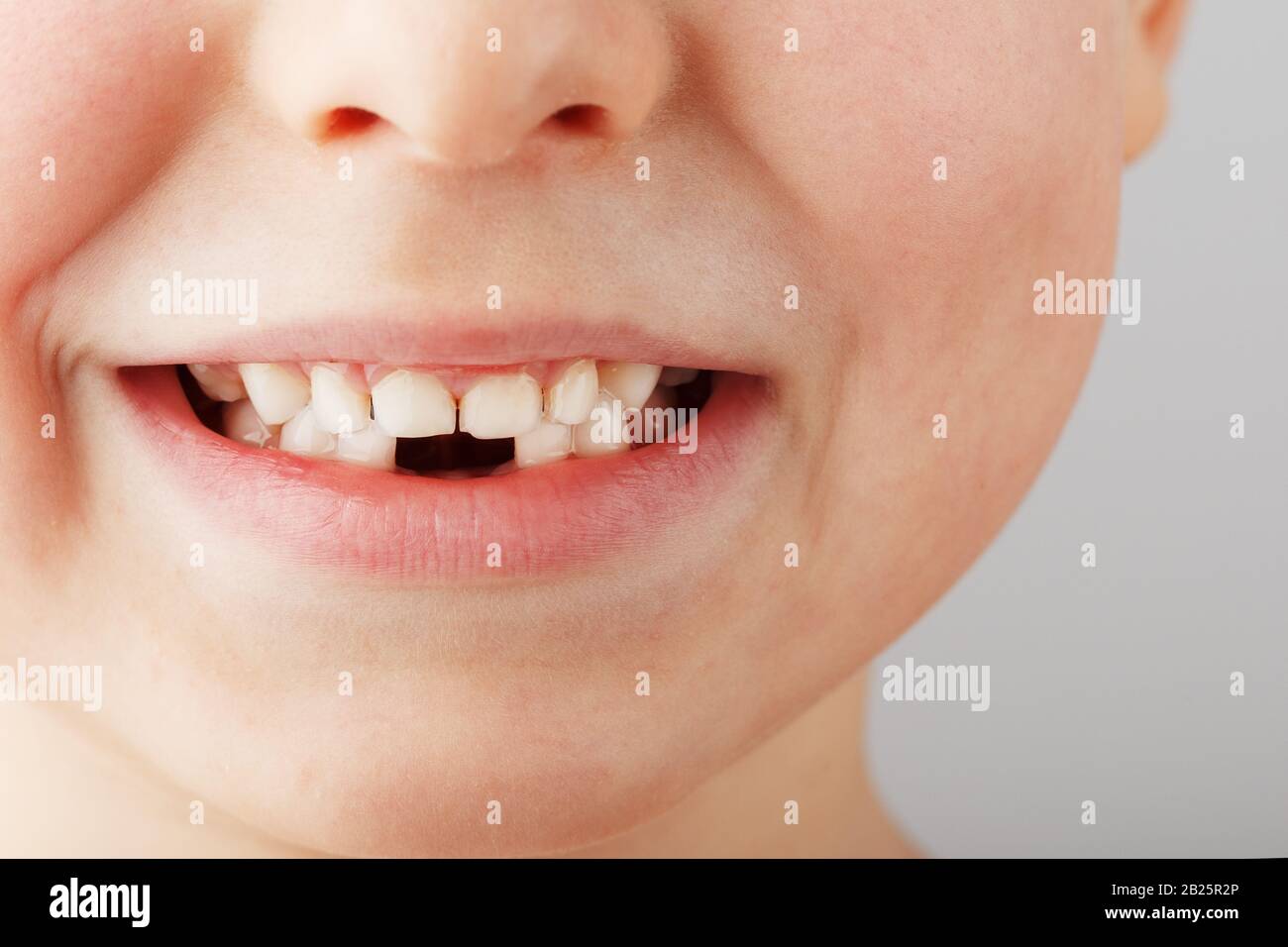 A child's smile without lower baby teeth. A hole in a child's smile ...