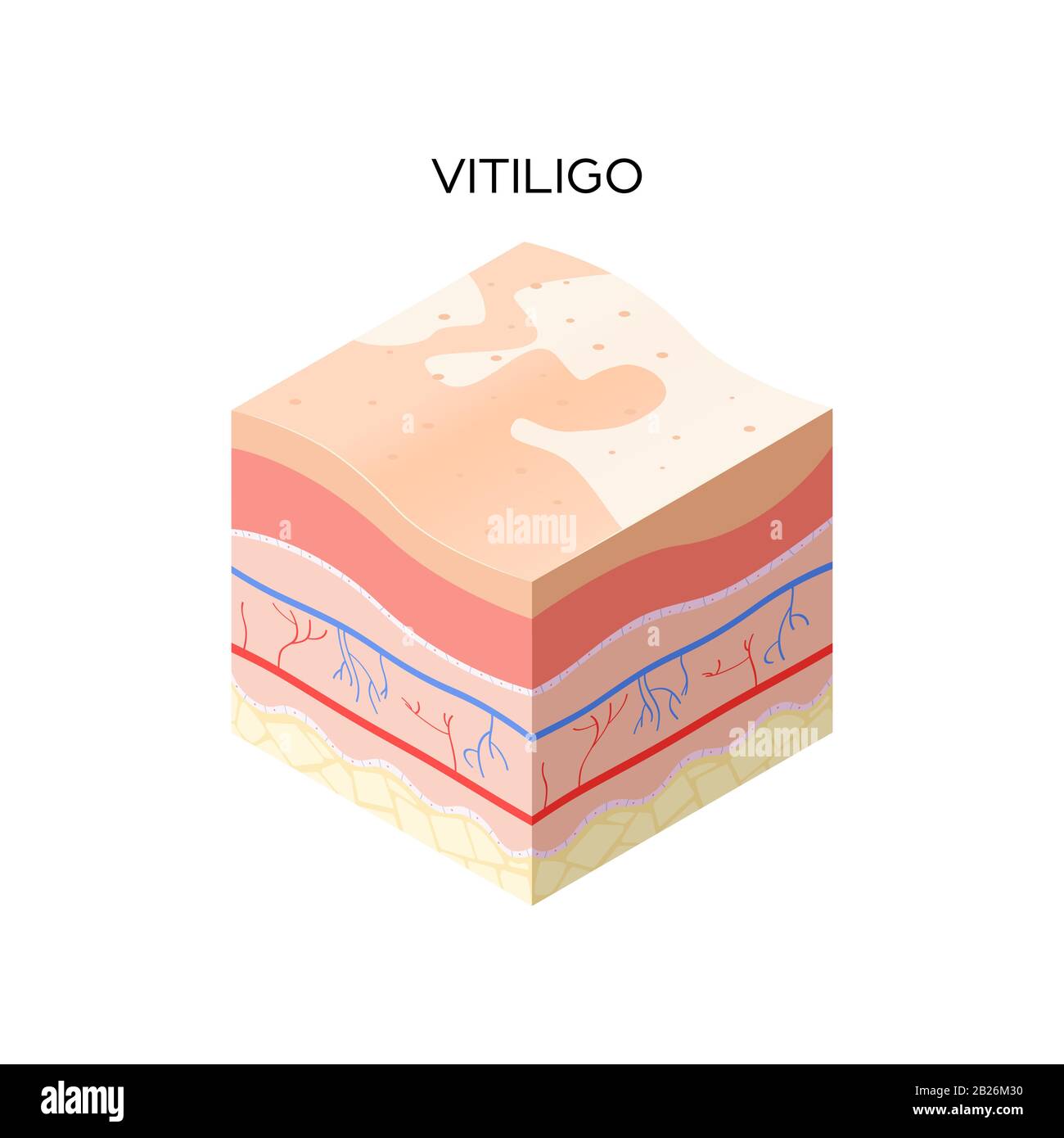 vitiligo skin cross-section of human skin layers structure skincare ...