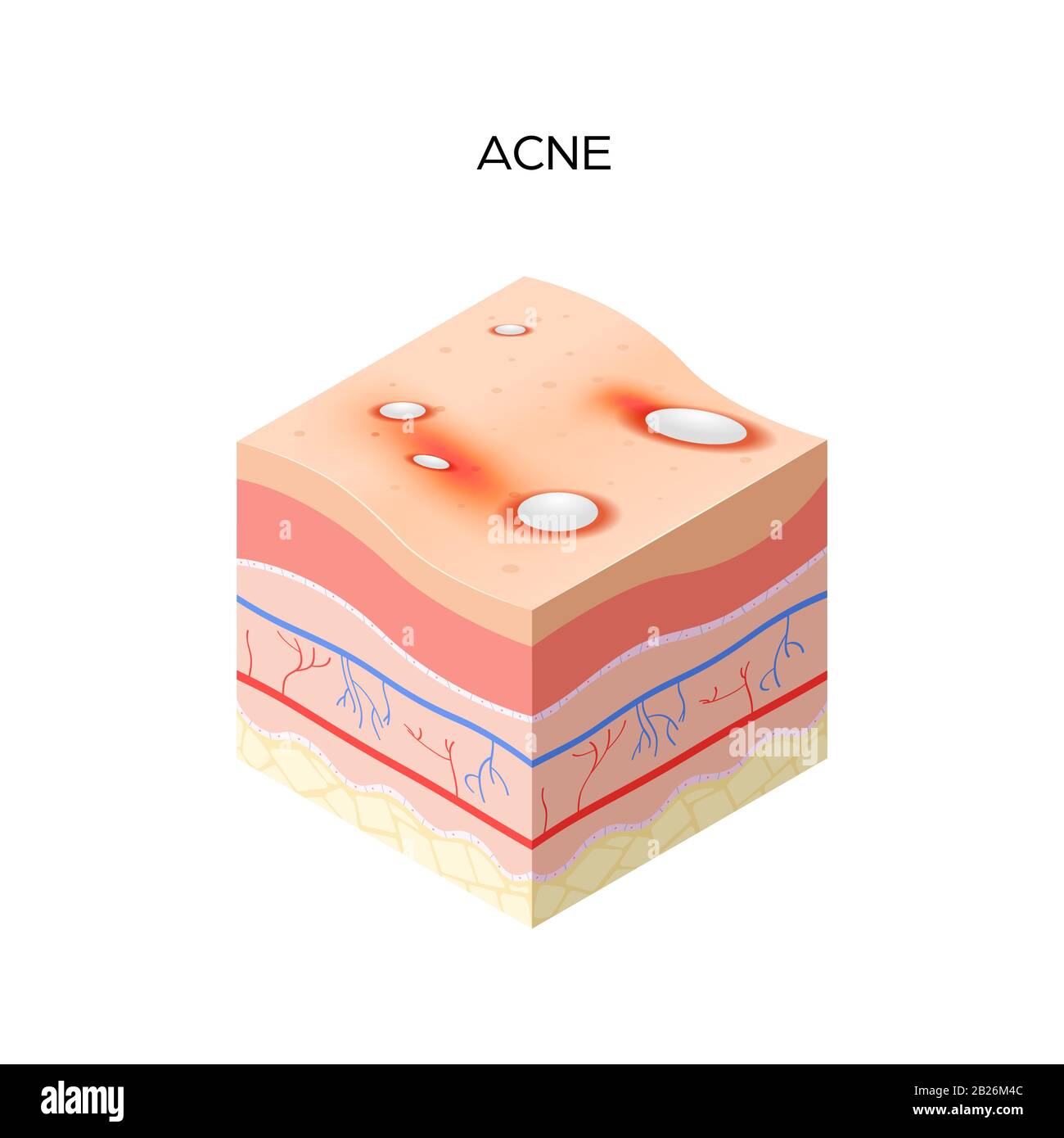 Acne vulgaris or pimple cross-section of human skin layers structure ...
