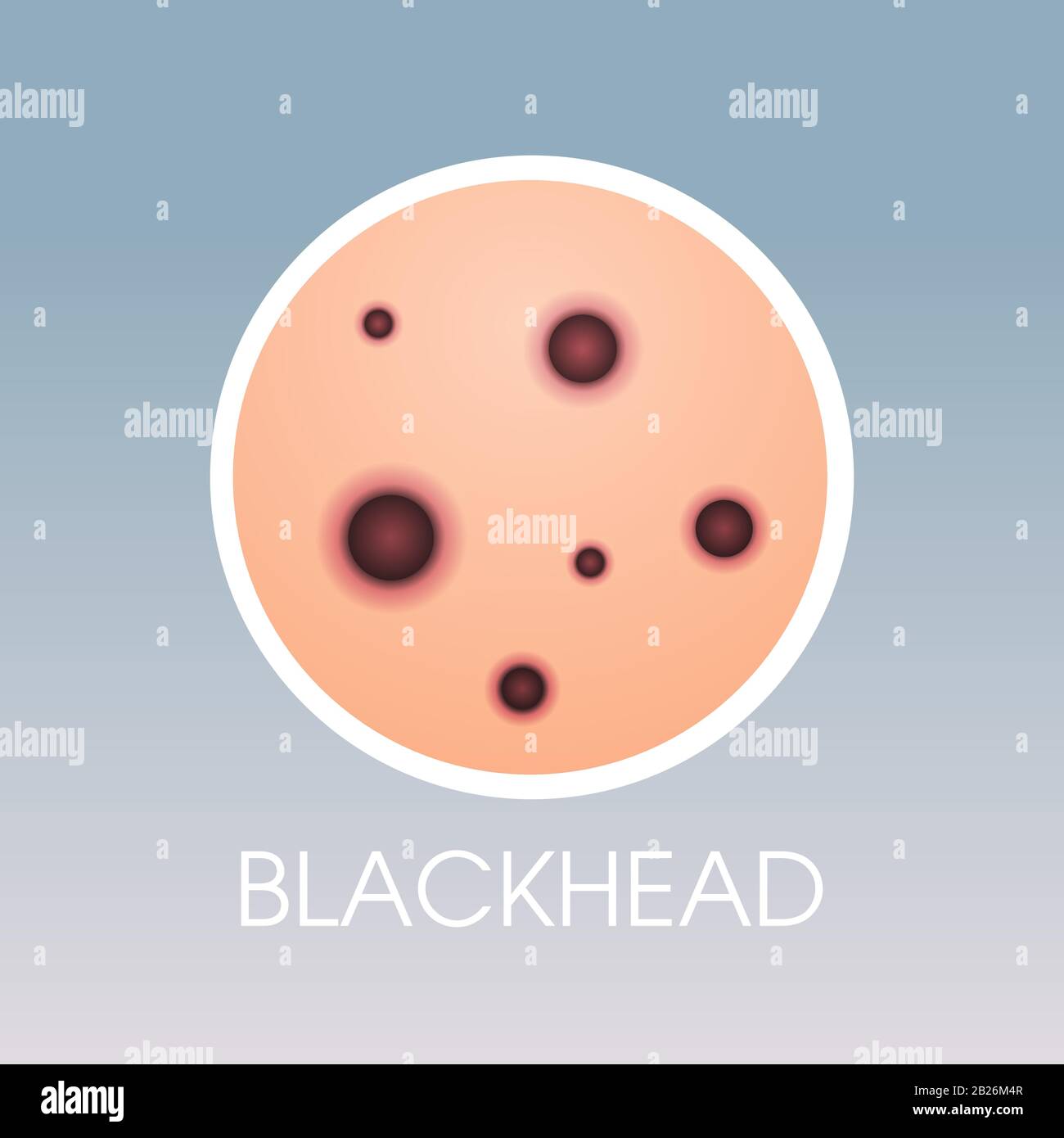 skin blackhead pimples acne type face pore comedones cosmetology ...