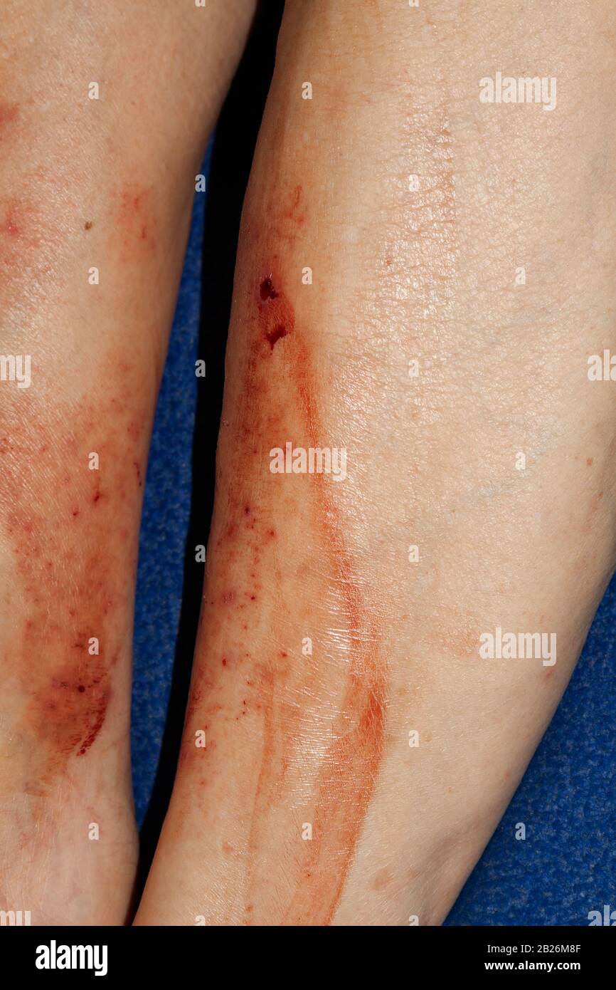 Bloody scratched due to massive itching, Neurodermatitis respectively ...