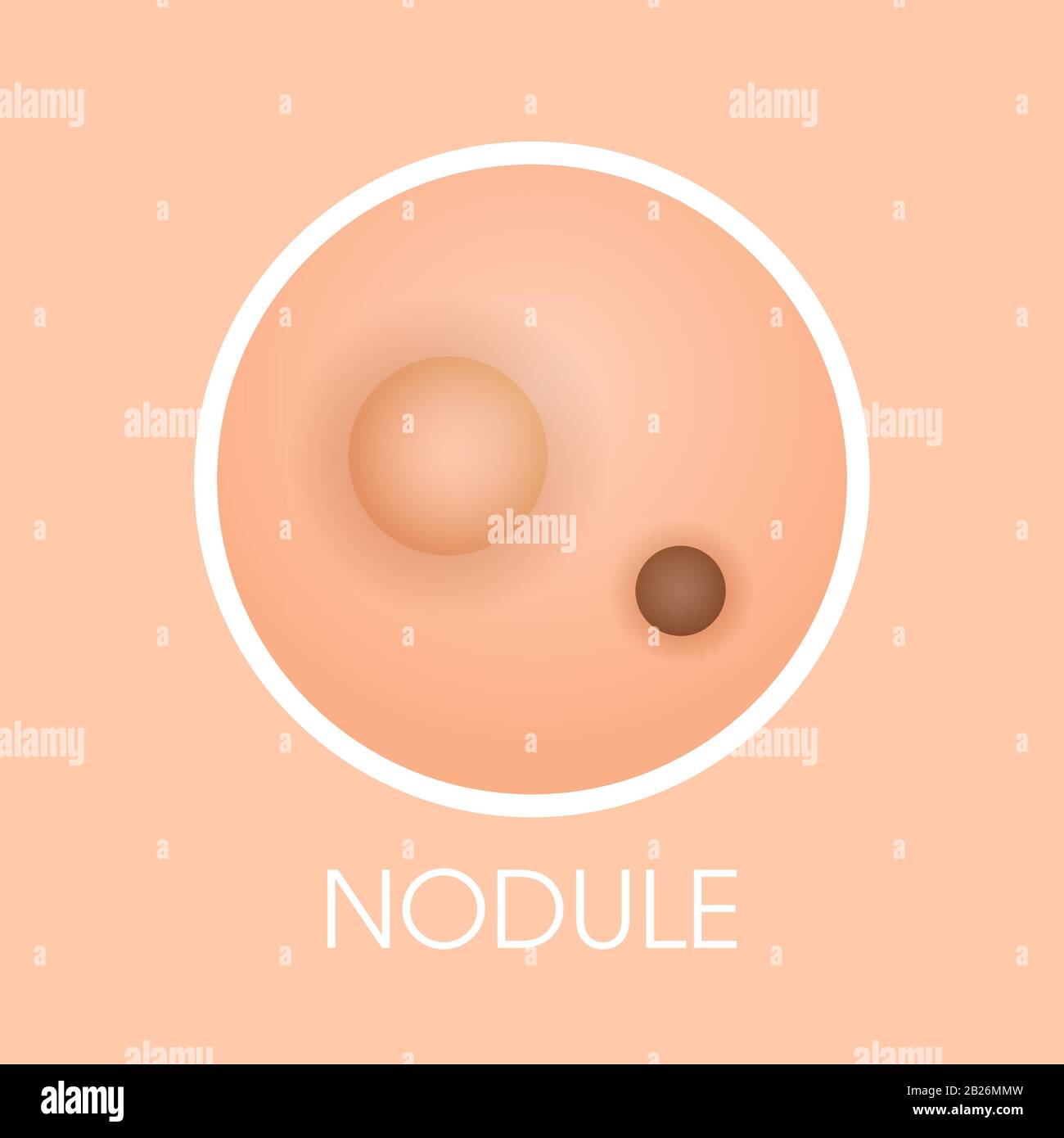 Skin nodule hi-res stock photography and images - Alamy