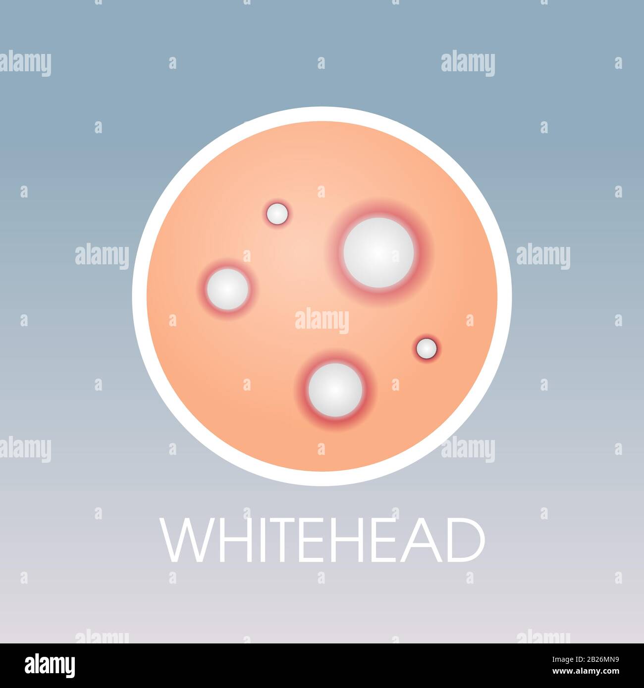 Scar formation Stock Vector Images - Alamy
