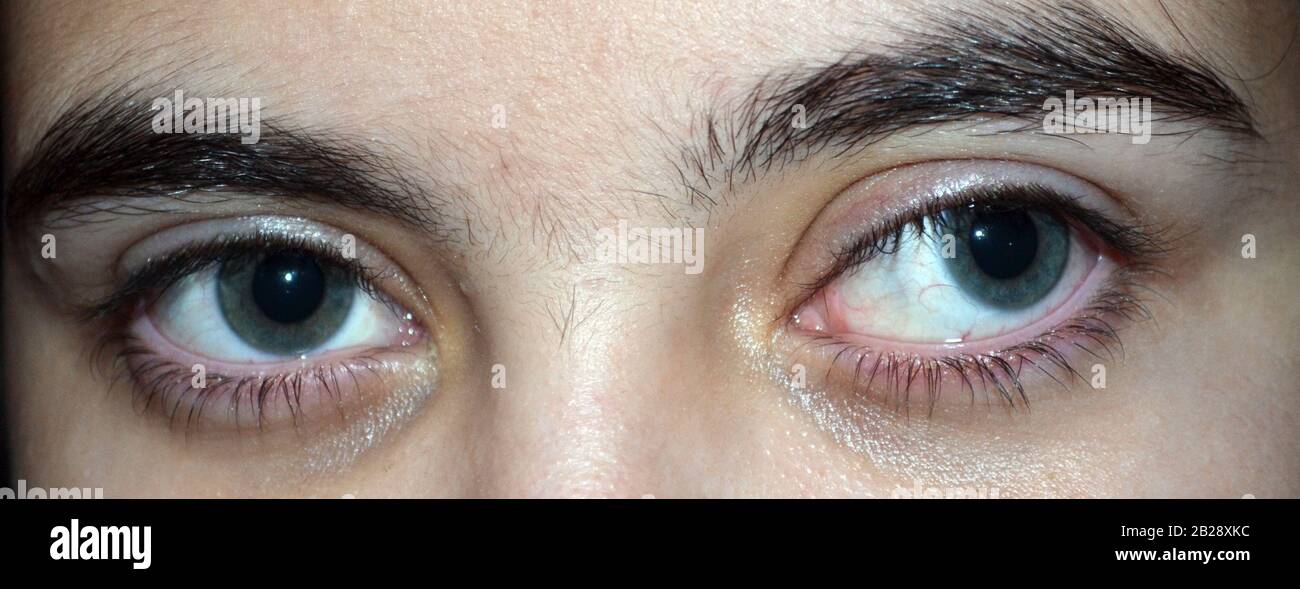 Exotropia hi-res stock photography and images - Alamy