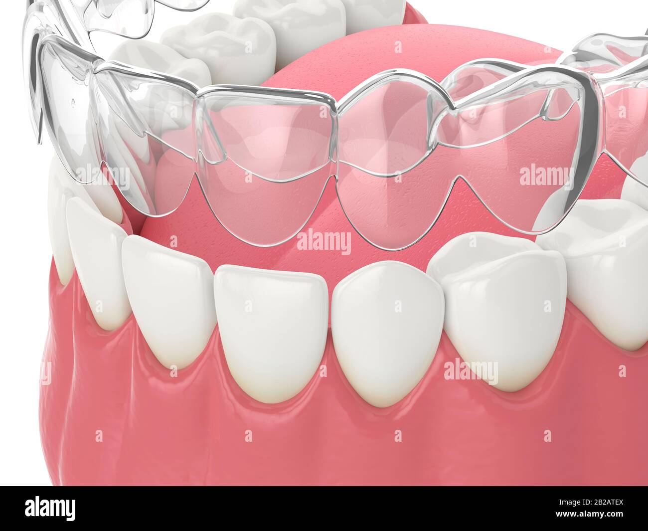 3d render of invisalign removable and invisible retainer with lower jaw ...