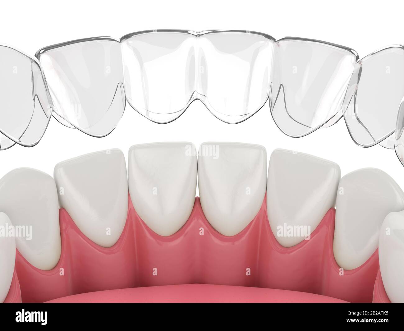 3d render of invisalign removable and invisible retainer with lower jaw ...