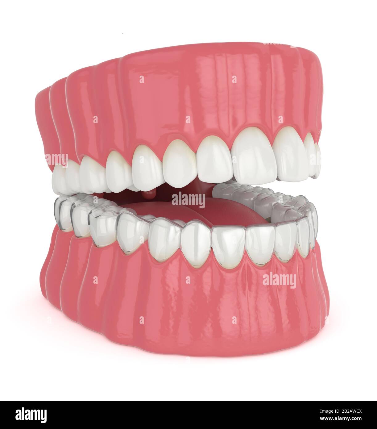 3d render of jaw with invisalign removable retainer over white ...