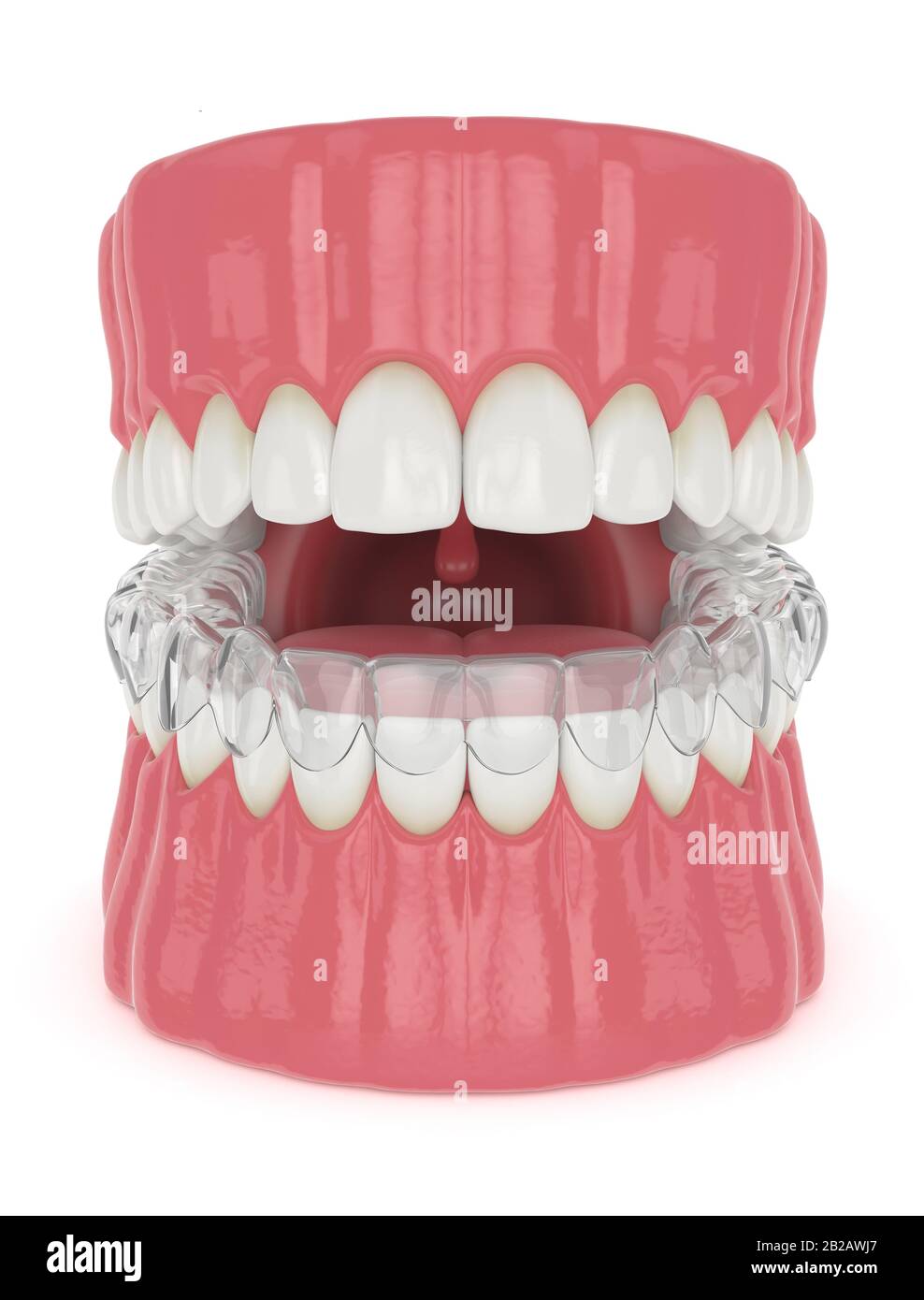 3d render of jaw with invisalign removable retainer with jaw over white ...