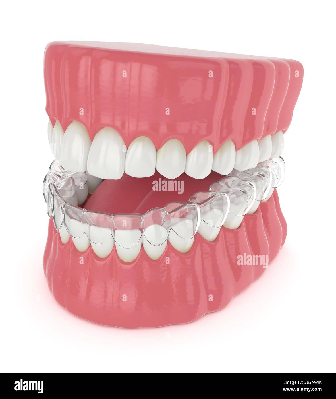 3d render of jaw with invisalign removable retainer over white ...