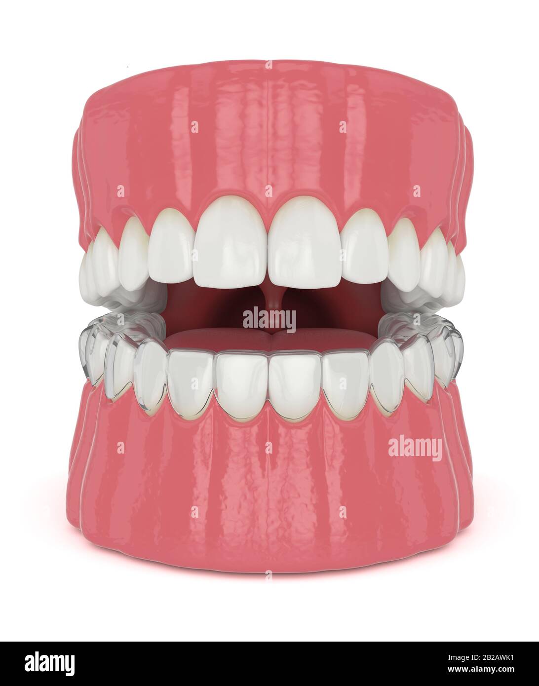 3d render of jaw with invisalign removable retainer over white ...