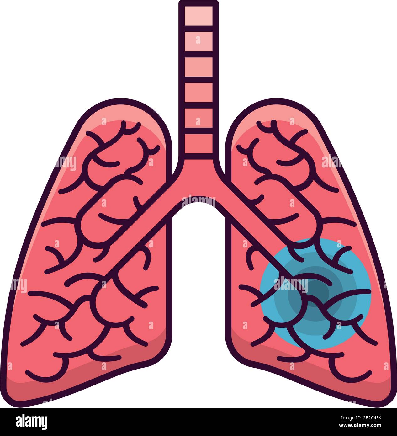 Infected human lungs vector illustration isolated. Serious lung disease ...