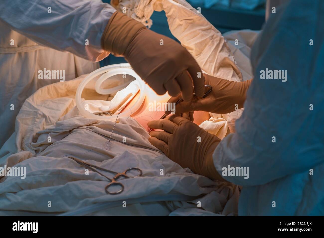 close-up hands of pediatric surgeons perform surgery using laparoscopic ...
