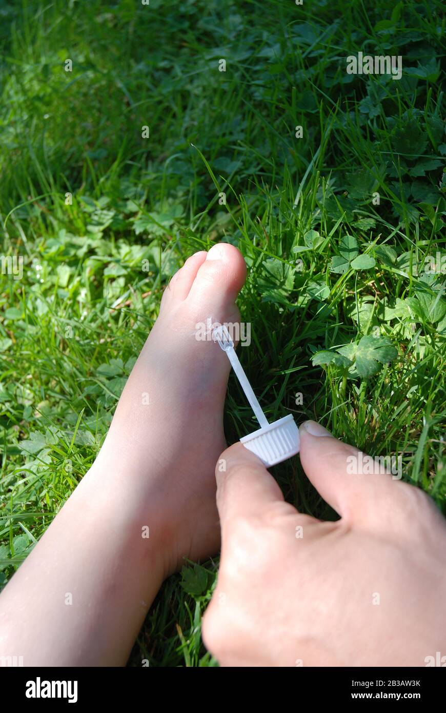 Treatment of a wart on a kids leg outdoor in the grass Stock Photo - Alamy
