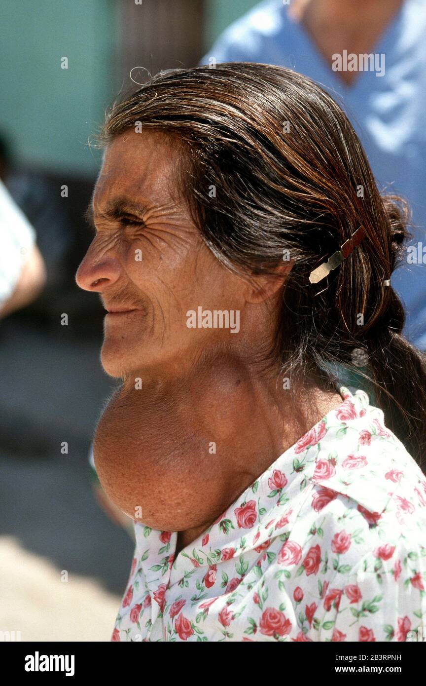 Goiter enlargement of thyroid hi-res stock photography and images - Alamy