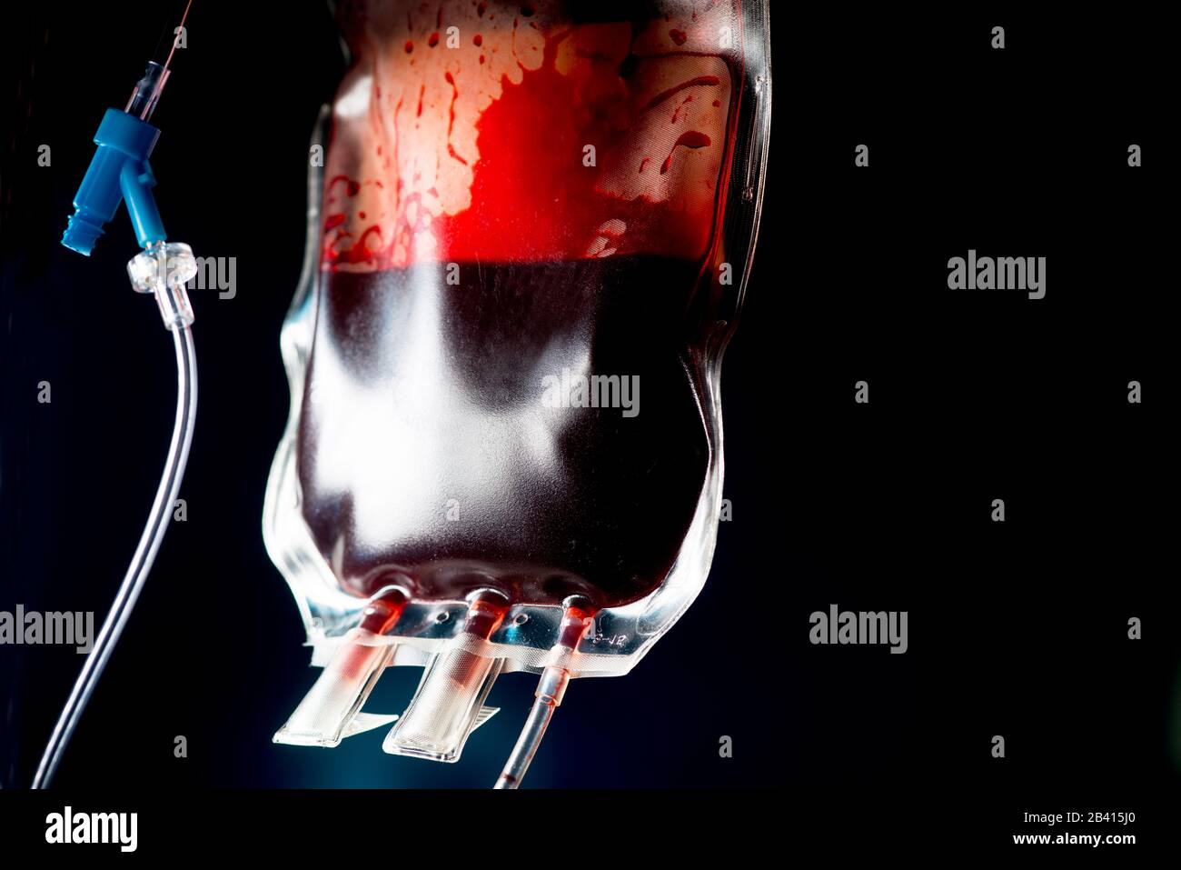 Donor blood unit hanging on IV pole with IV tubing on dark backround ...