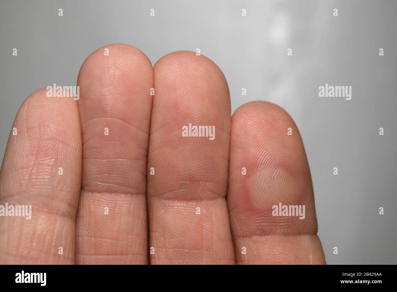 Blister skin burn hi-res stock photography and images - Alamy