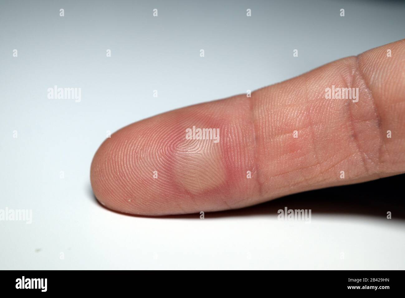 Burn scar hand hi-res stock photography and images - Alamy