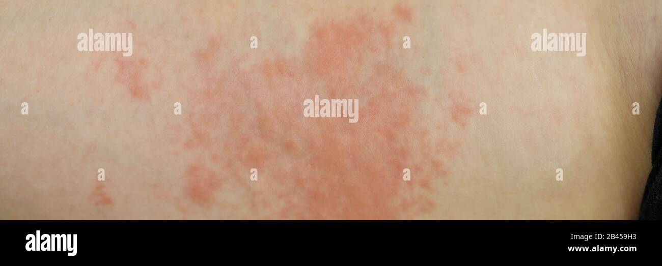 Skin Infection Stock Photos & Skin Infection Stock Images - Alamy