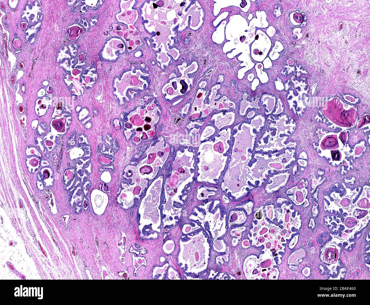 Low magnification of a human prostate gland in a 70-year-old man. The ...
