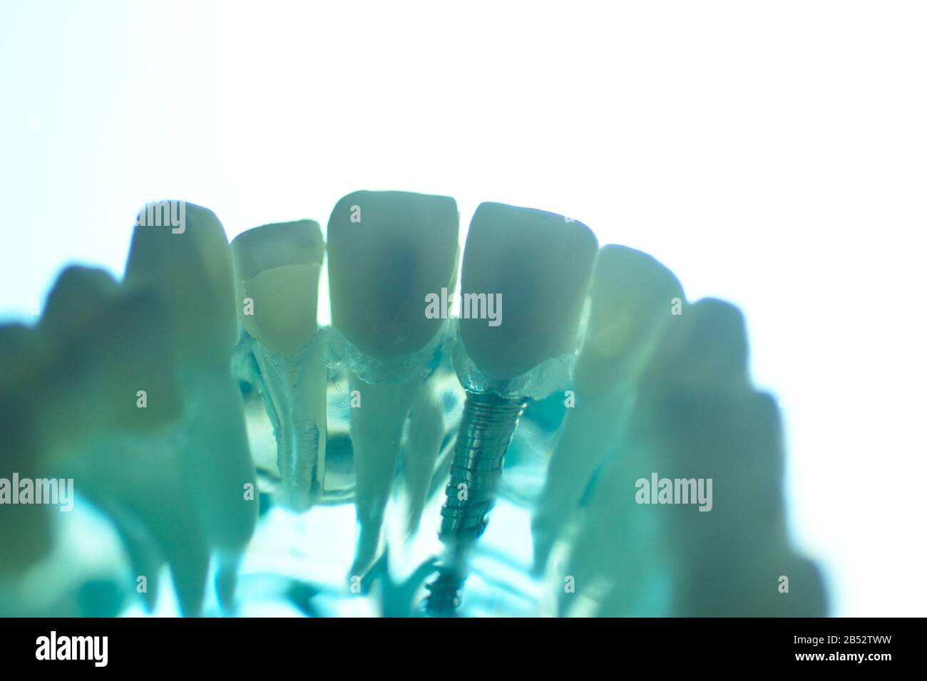 Dental tooth teaching model showing prosthetic teeth and gums Stock ...