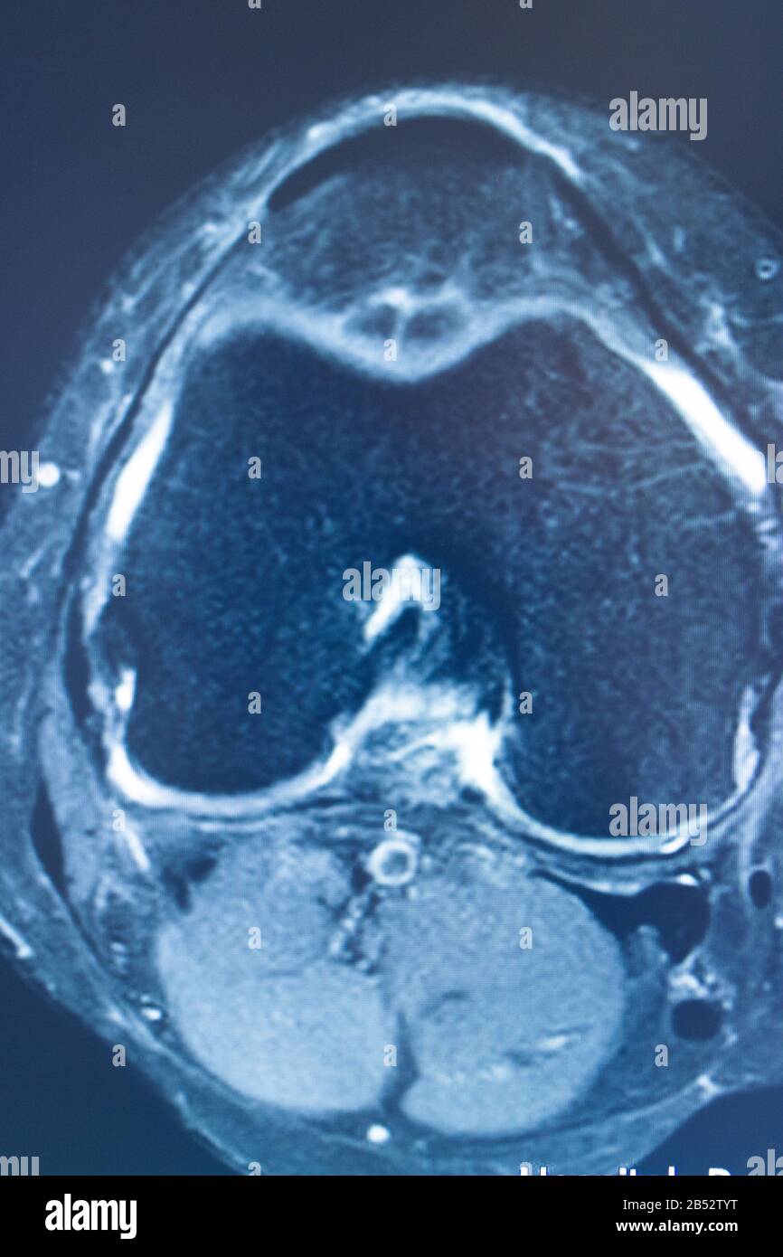 Knee sports injury mri mcl grade 2 tear magnetic resonance imaging ...