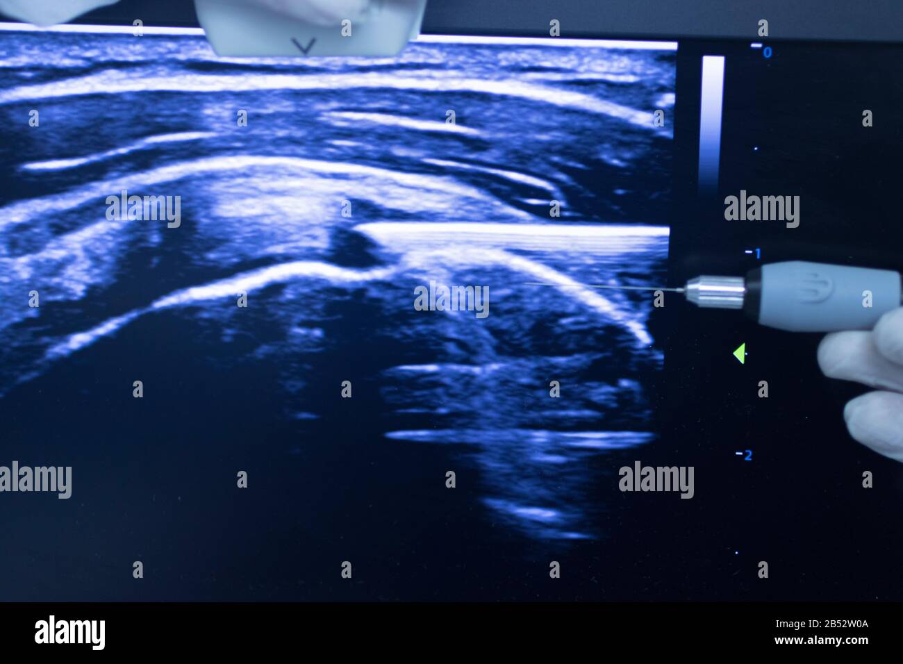 Epi percutaneous intratissue electrolysis scan hi-res stock photography and images - Alamy