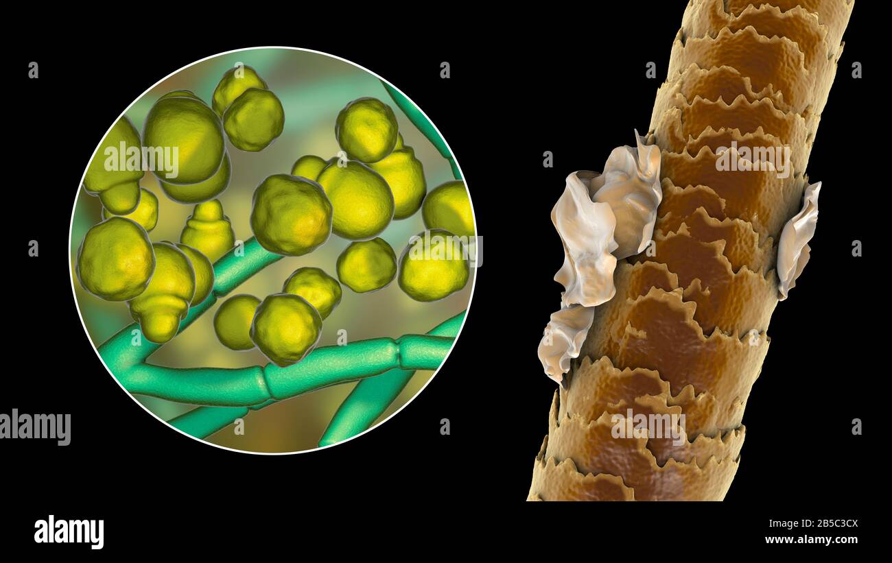 Human hair with dandruff, illustration Stock Photo - Alamy