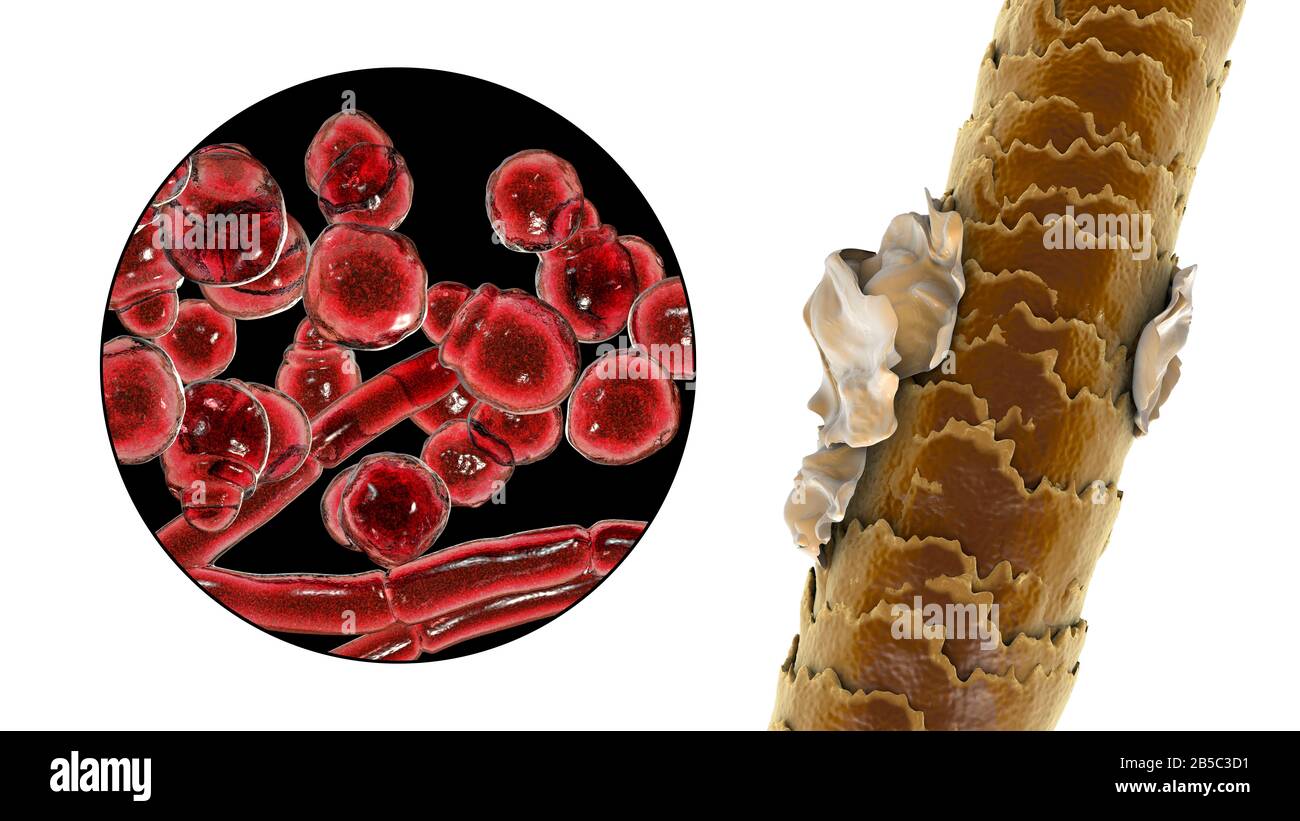 Human hair with dandruff, illustration Stock Photo - Alamy