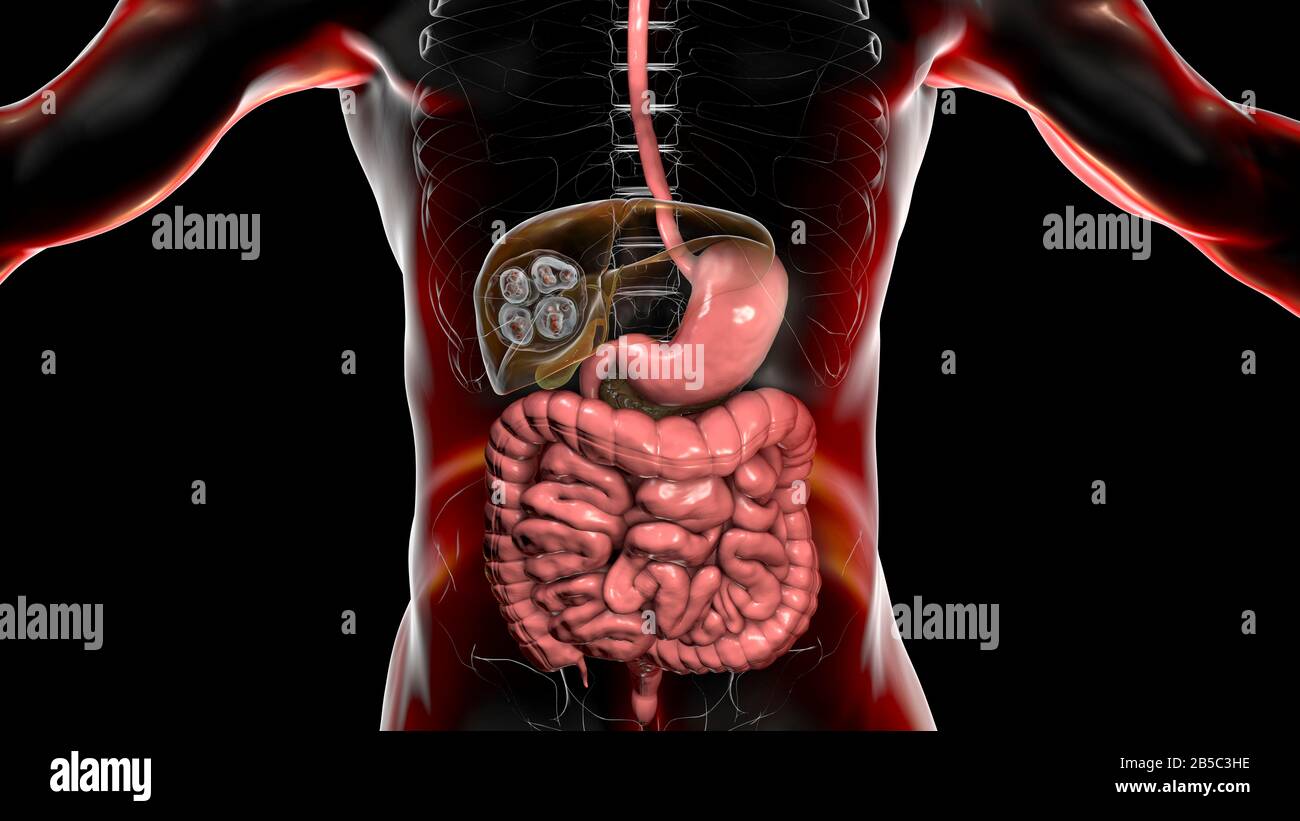 Hydatid disease in liver, alveolar echinococcosis, illustrat Stock ...