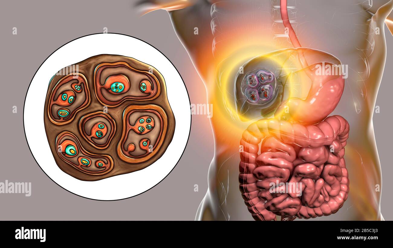 Echinococcus Multilocularis Liver