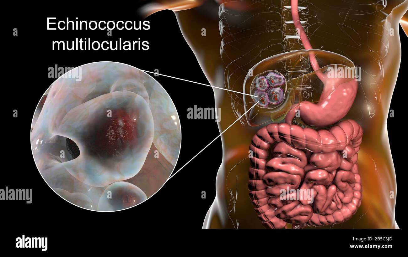 Hydatid disease in liver, alveolar echinococcosis, illustrat Stock ...
