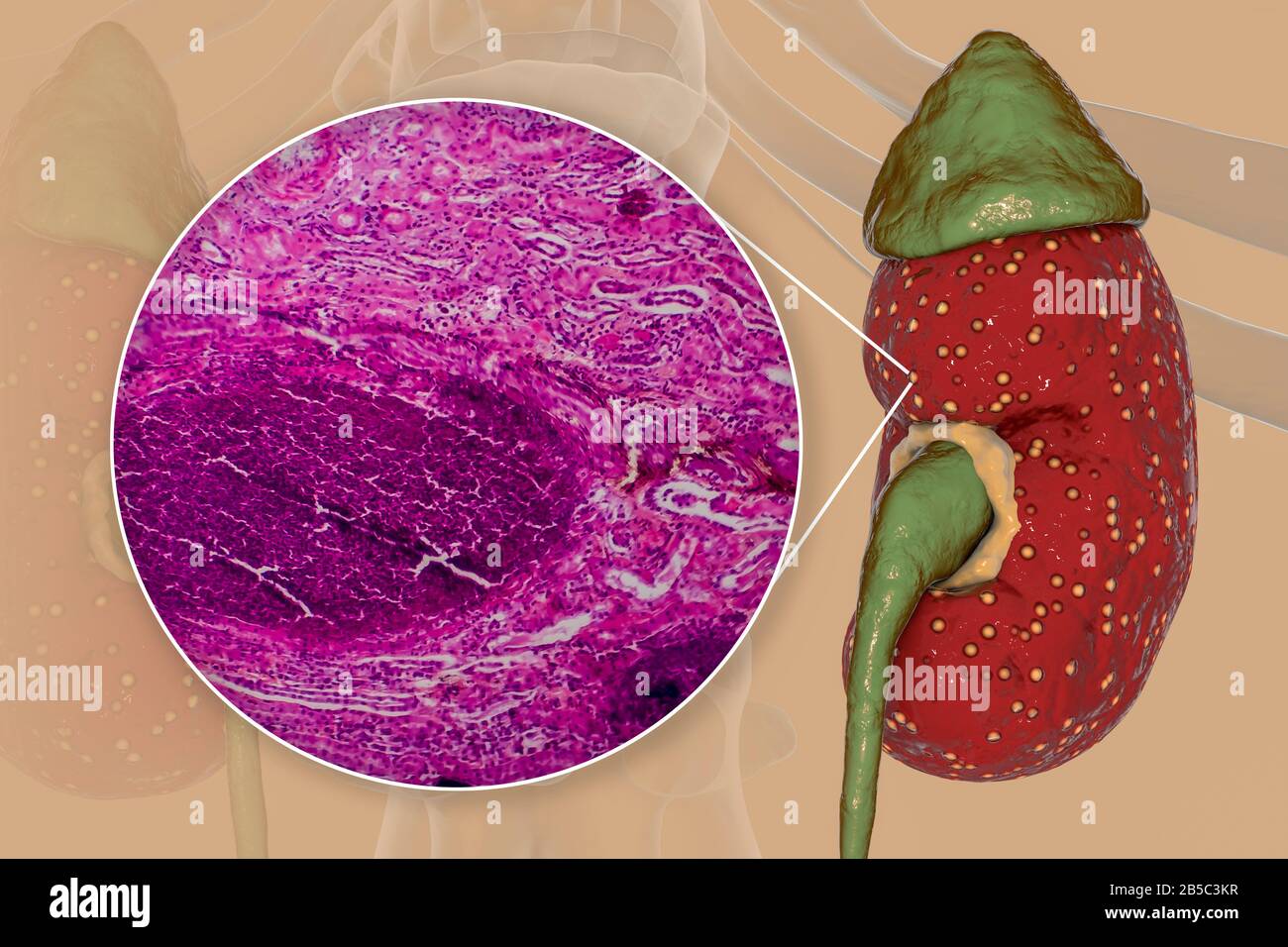 Acute pyelonephritis, illustration and light micrograph Stock Photo - Alamy