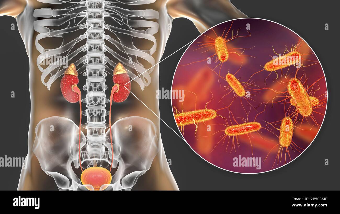 Acute pyelonephritis caused by E coli, illustration Stock Photo - Alamy