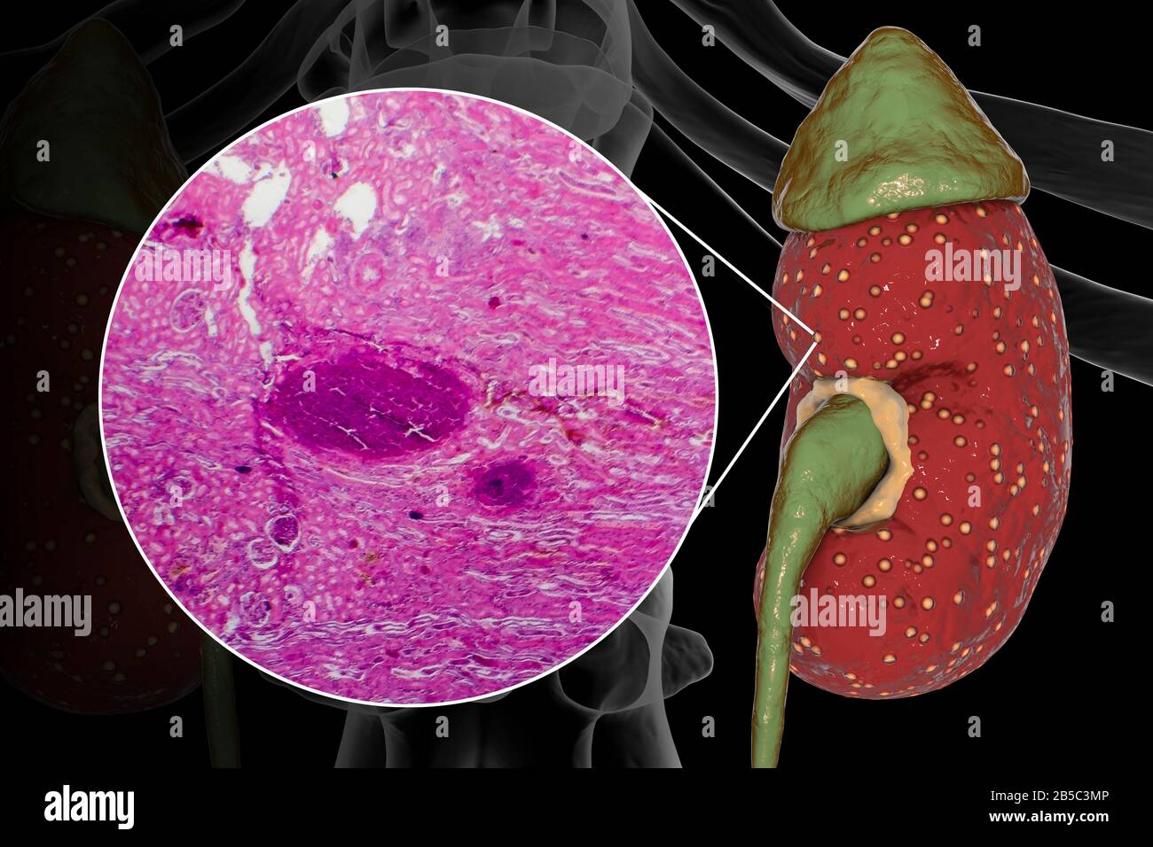 Acute pyelonephritis, illustration and light micrograph Stock Photo - Alamy