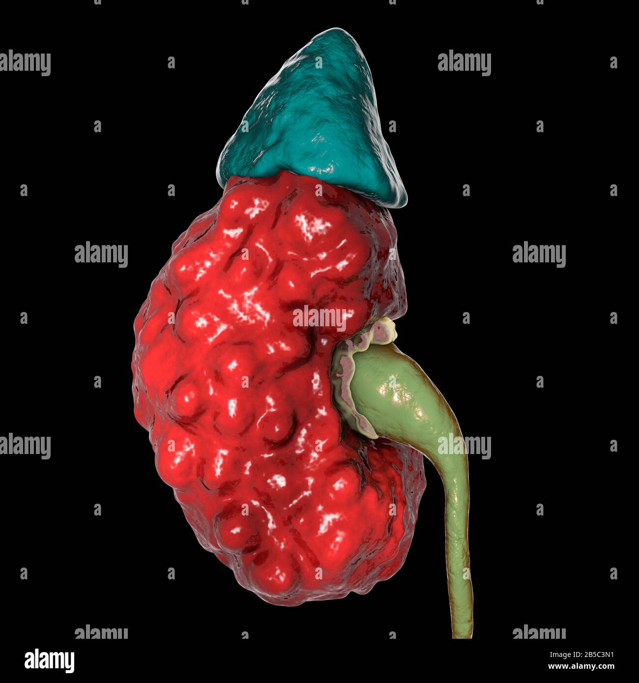 Chronic pyelonephritis, illustration Stock Photo - Alamy
