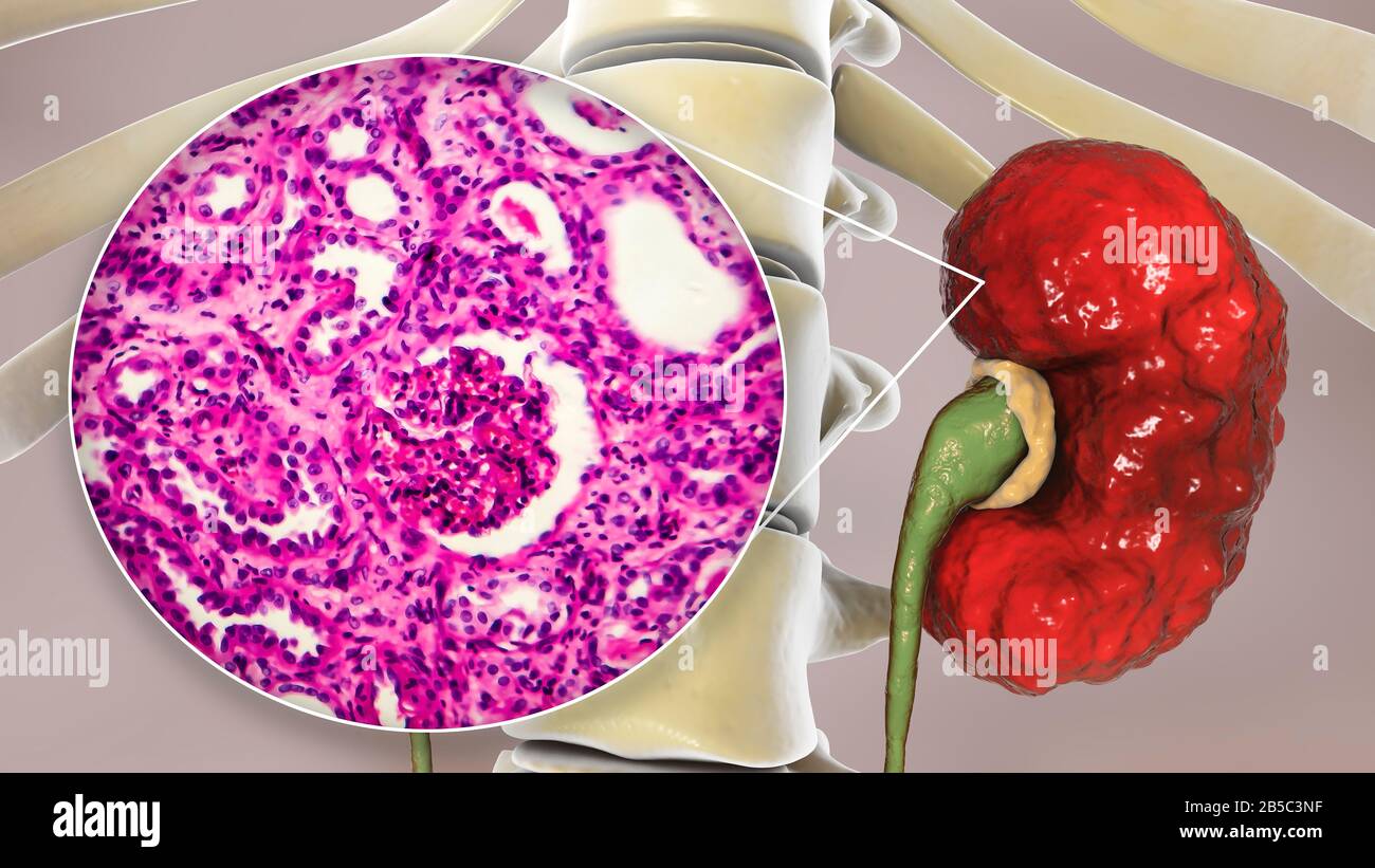 Chronic Pyelonephritis