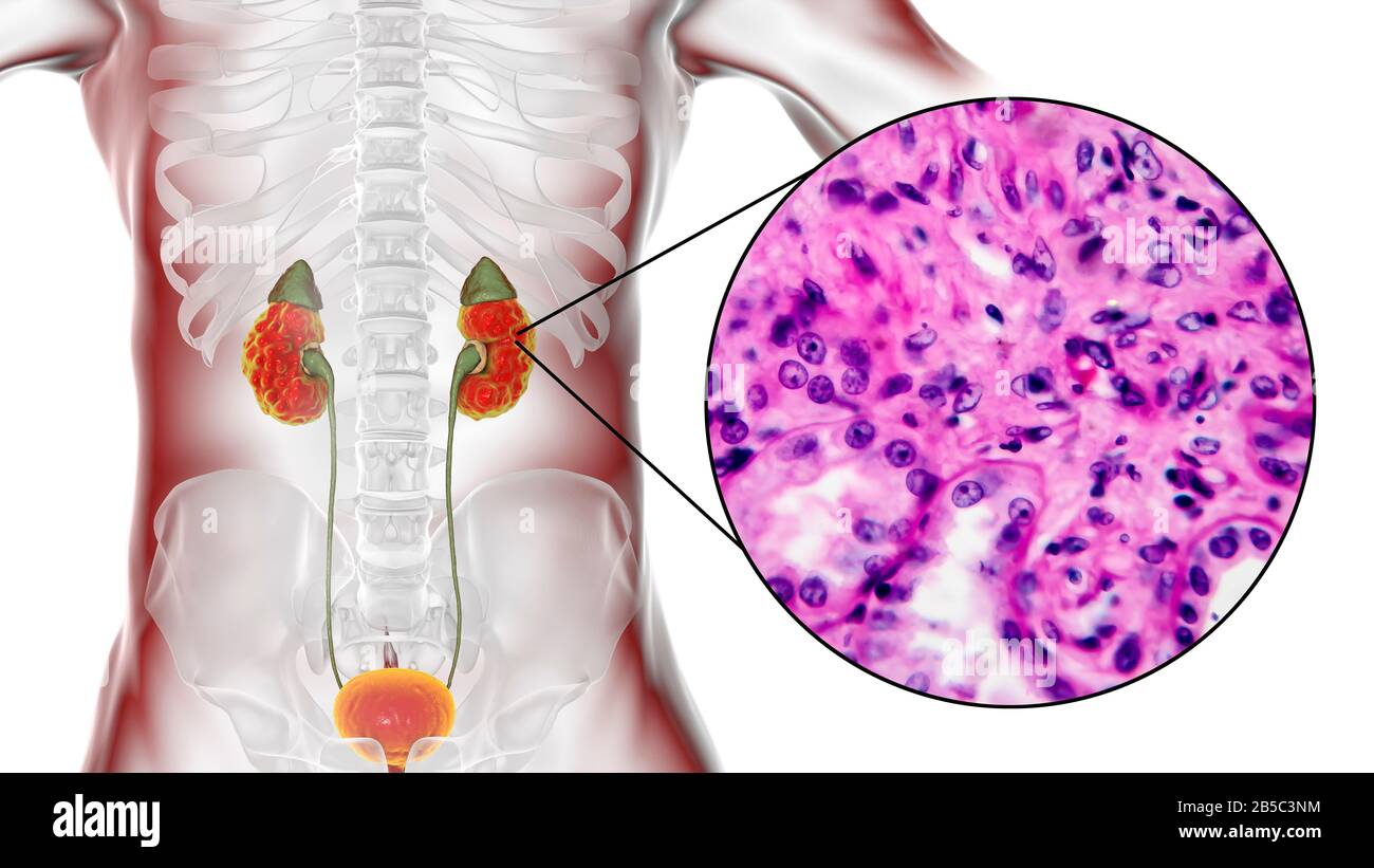 Chronic pyelonephritis, illustration and light micrograph Stock Photo ...