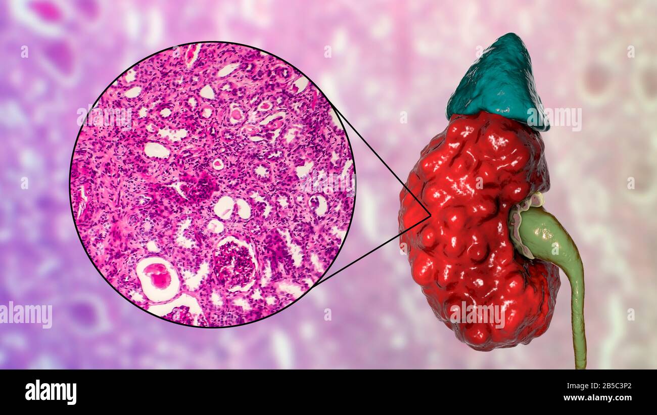 Chronic pyelonephritis, illustration and light micrograph Stock Photo ...