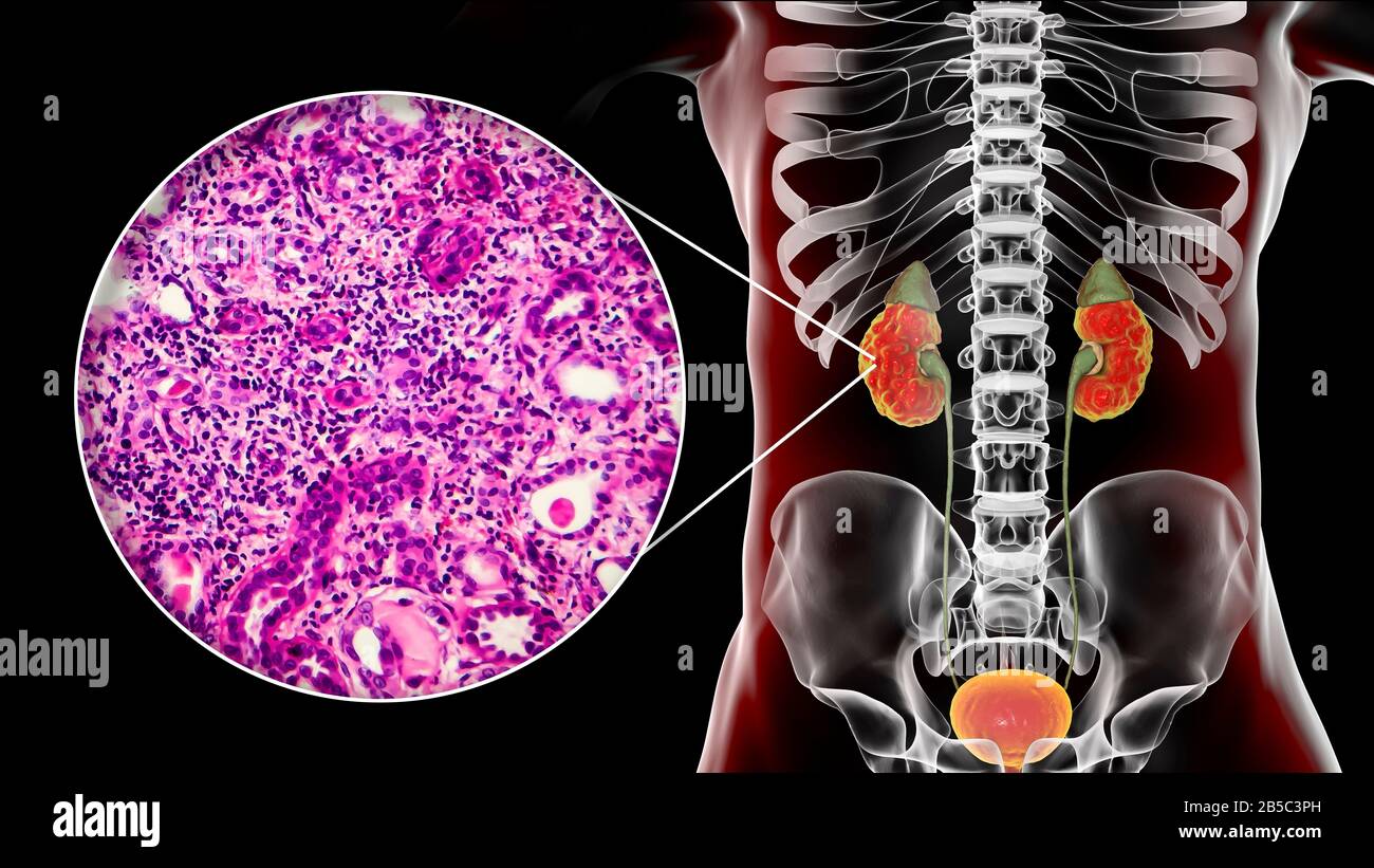 Chronic pyelonephritis, illustration and light micrograph Stock Photo ...