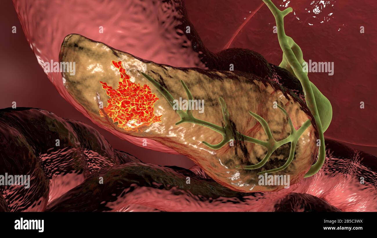 Pancreatic cancer, illustration Stock Photo - Alamy