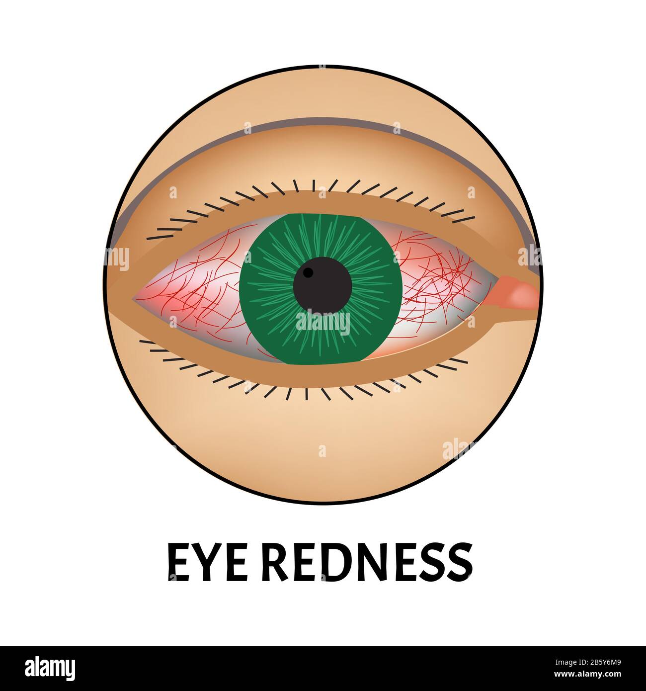 Redness of the eyes. Symptom of conjunctivitis, allergies, inflammation ...